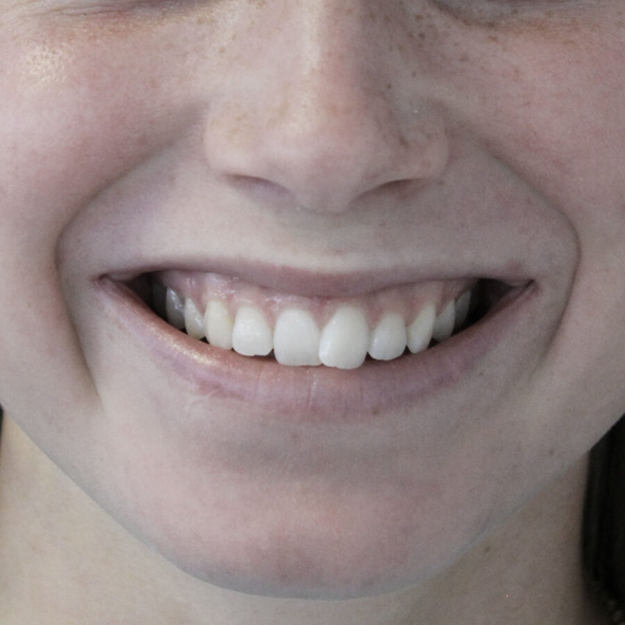Før/efter-billeder af Botox - AK Aesthetics